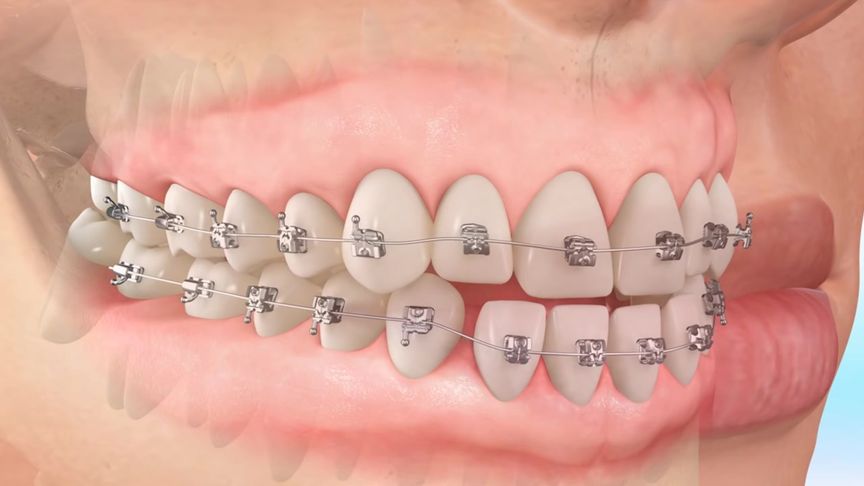 牙齿矫正的流程是怎样的!