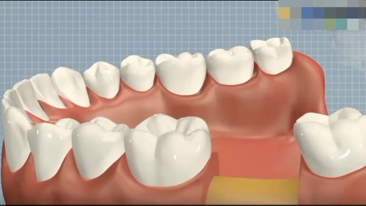 史上最全种植牙全过程,看不懂的你打死我~