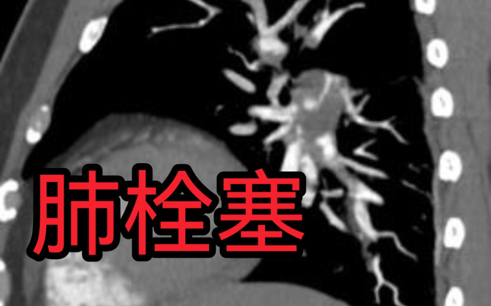 【影像读片】肺栓塞 | 肺动脉CTA | 影像报告书写