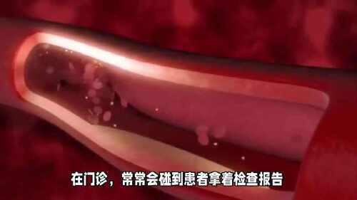血管堵到多少不能放支架?医生揭秘支架手术的临界点