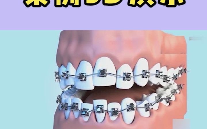 牙齿矫正全过程(动画演示)