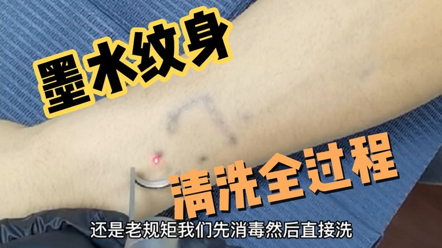 洗一枚用针扎的墨水纹身,恢复后还剩一点残留,接着安排。