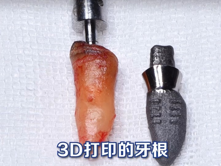 唐志辉教授3D打印种植牙开始临床试验了
