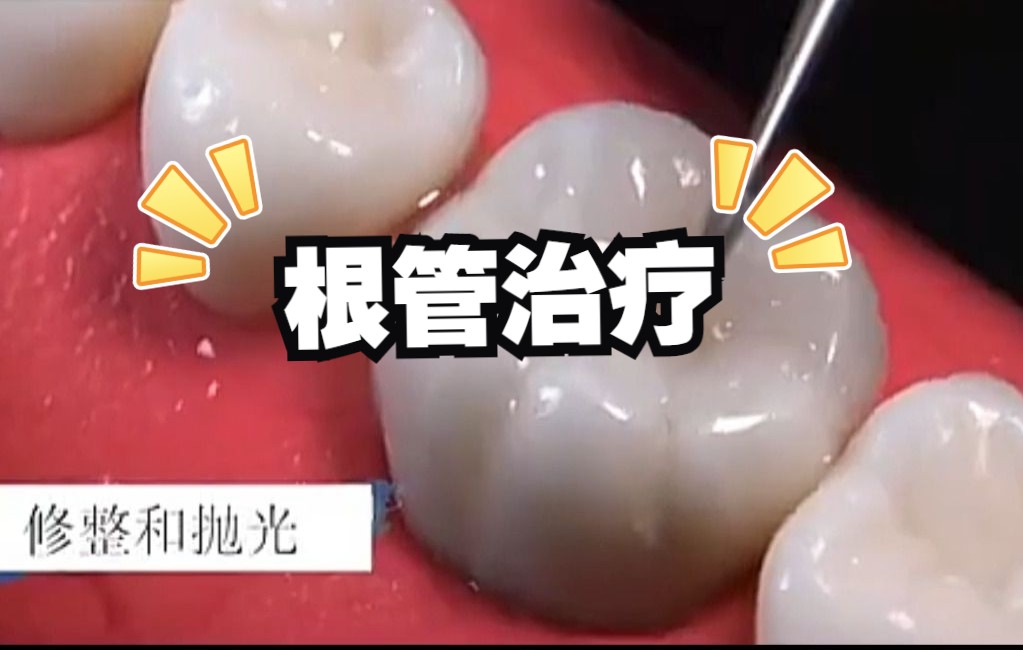 牙科医生的日常之根管治疗