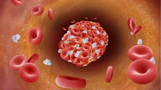 医学科普短片:3D动画演示血栓的形成和介入治疗方法