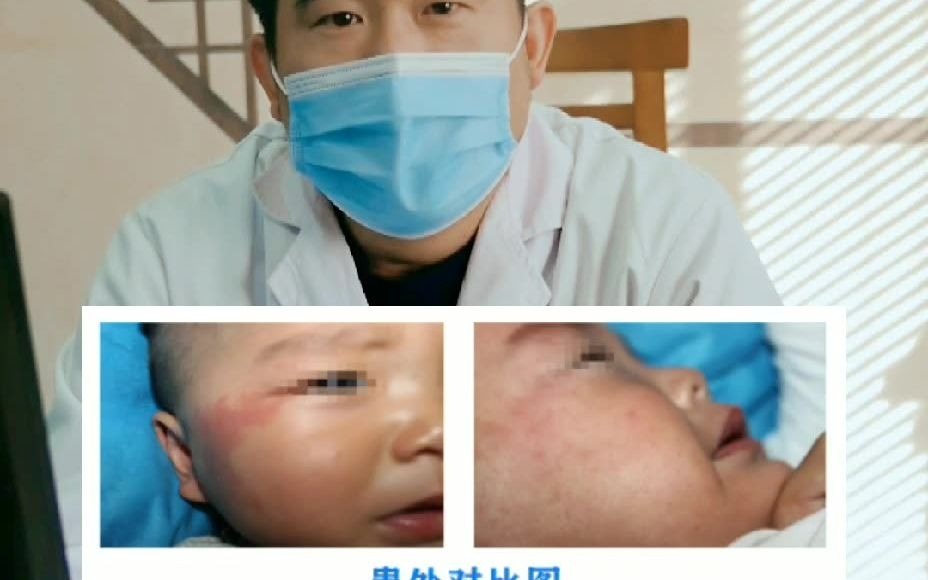 婴幼儿血红斑痣不可怕,血管瘤治疗方法很重要!