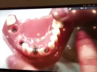 ITI种植取模