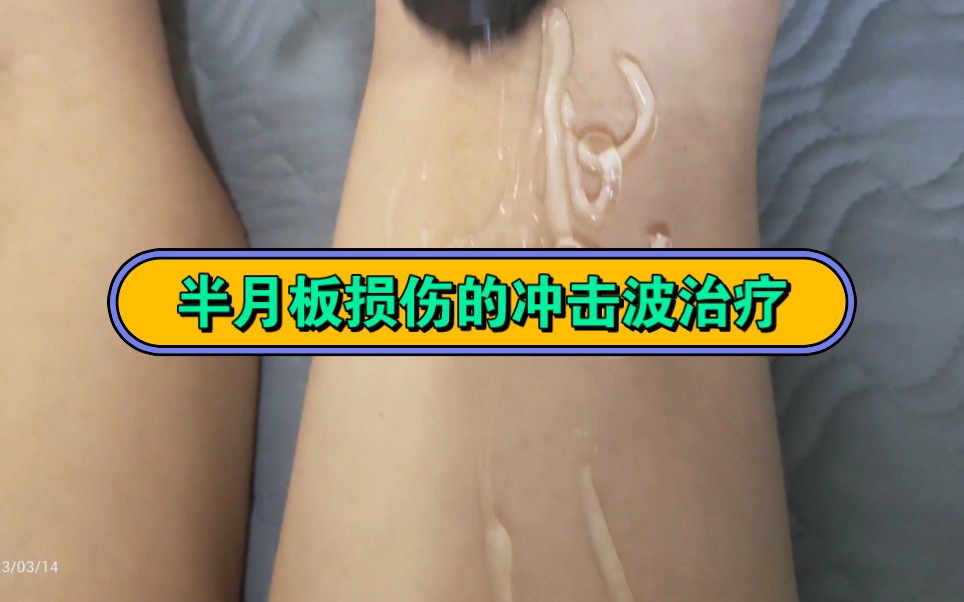 冲击波治疗是唯一对半月板损伤有修复效果的物理治疗方式