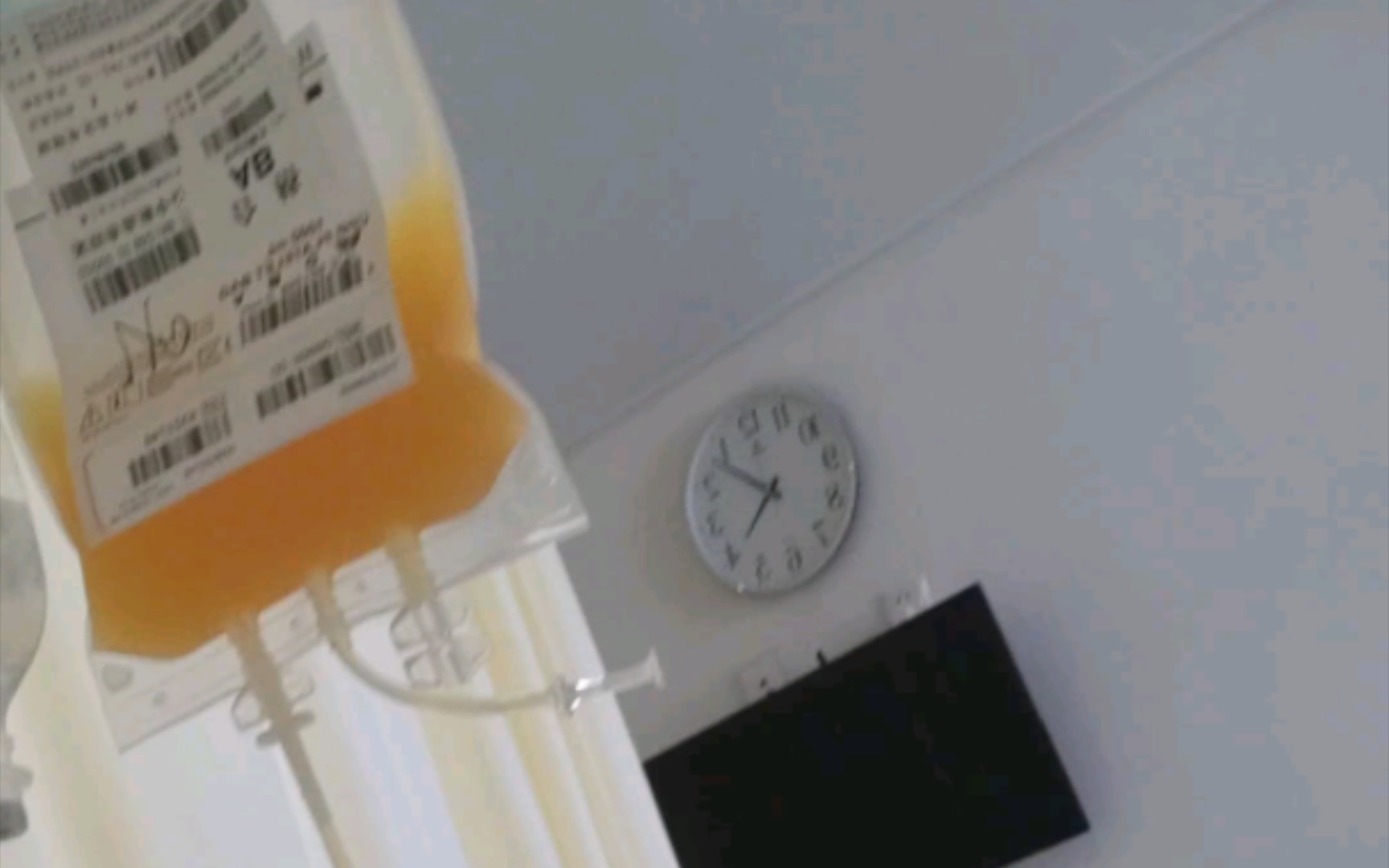 骨髓穿刺显示巨核细胞很多,只是不怎么产血小板。