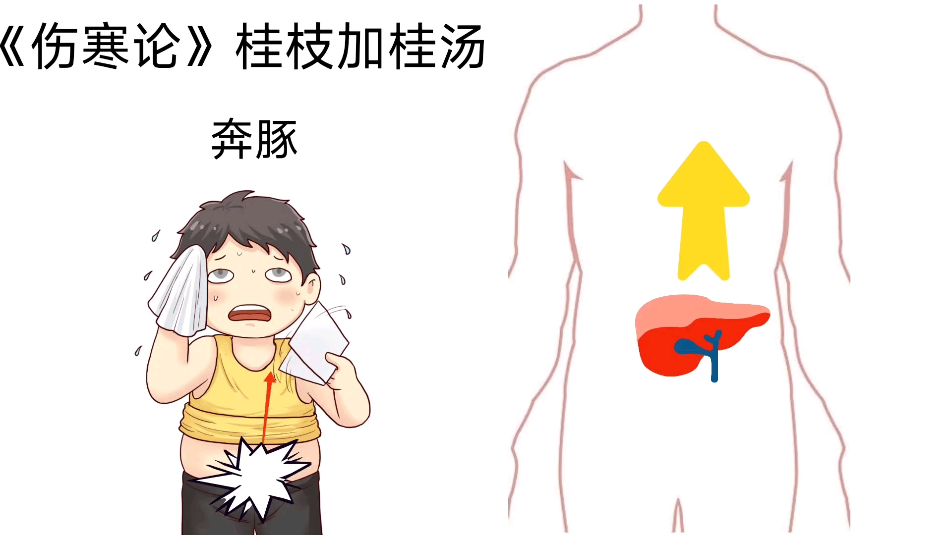 《伤寒论》桂枝加桂汤治疗奔豚气