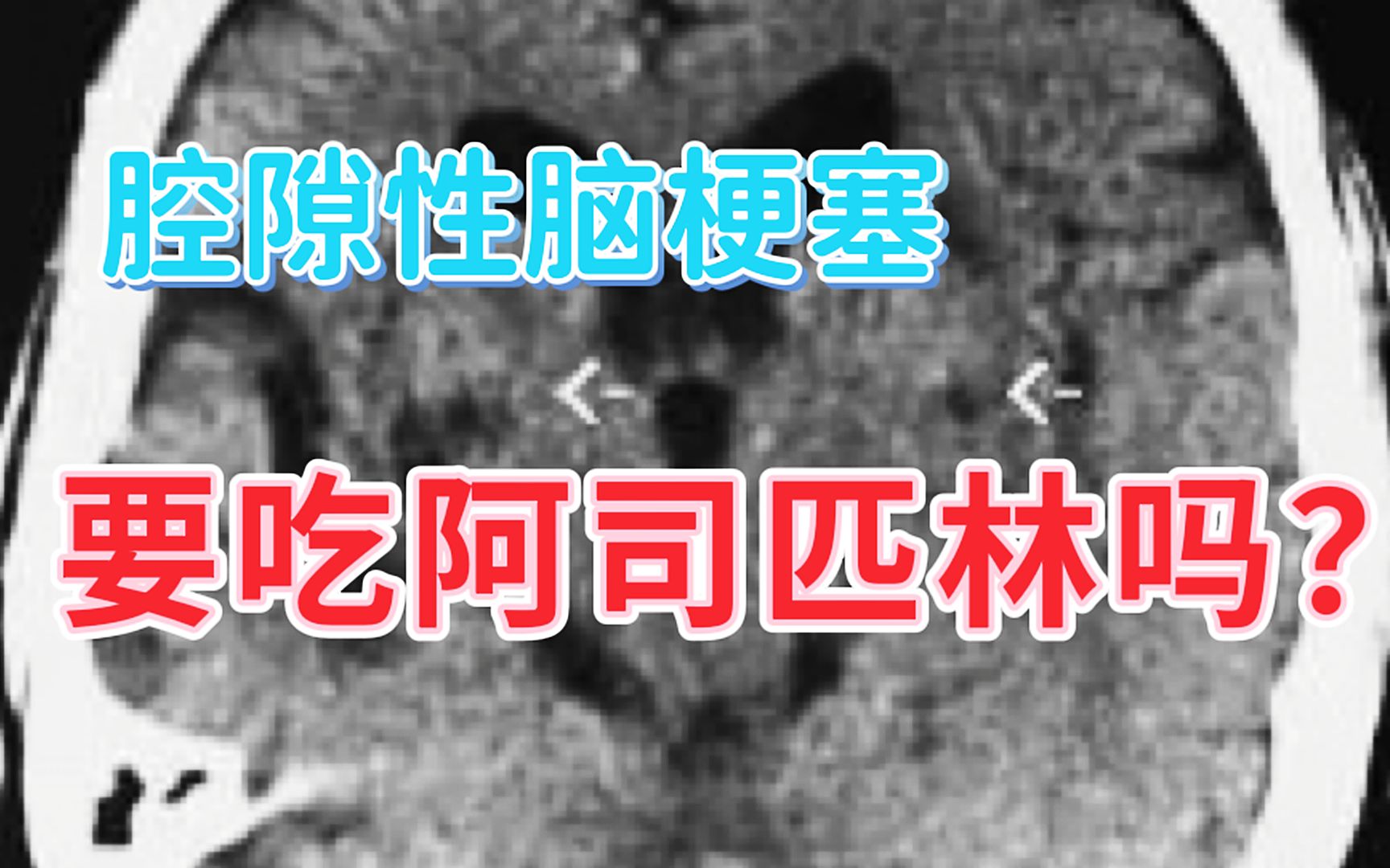 得了腔隙性脑梗塞,医生叫吃一辈子阿司匹林和他汀类,对不对?