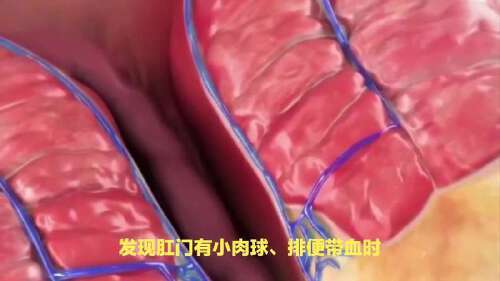 痔疮别再乱用土方法!这3大误区越试越严重,很多人已中招