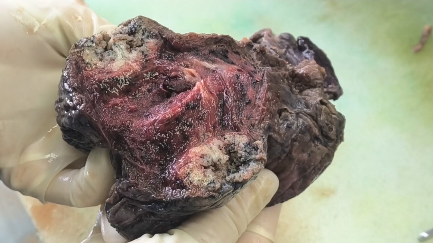 ...肺癌所在处肺膜破裂,其下可见一巨大肿物,与正常肺组织不同,它的...