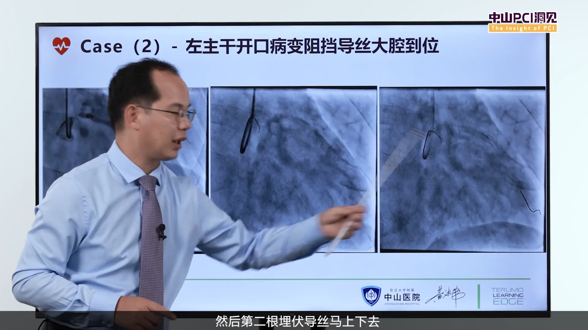 中山PCI洞见|77. 冠脉开口病变,如何选择和操控指引导管?
