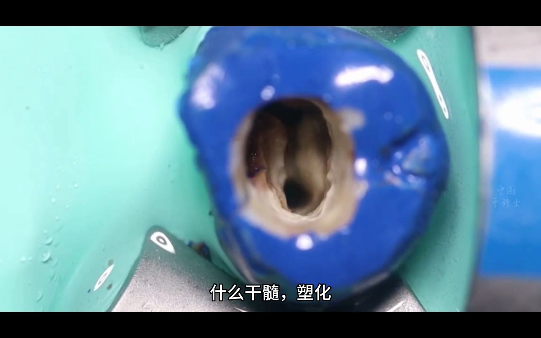 根管治疗全程,看起来真的痛