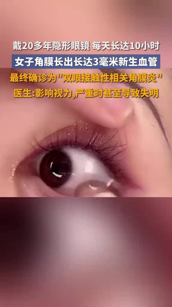 女子长期戴隐形眼镜致角膜长新生血管,医生:严重时甚至导致失明