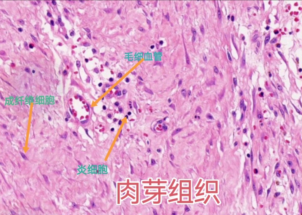 肉芽组织与心衰细胞组织切片
