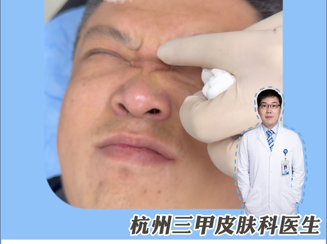 皮肤科博士|全脸肉毒素去皱提升 看看效果吧!