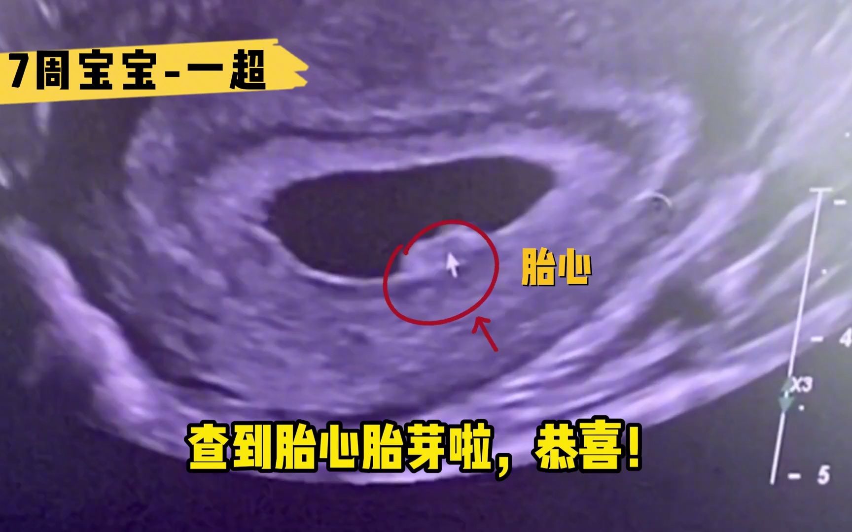 怀孕七周,一超查到胎心胎芽,看到跳动的小心脏,准妈妈感动哭了