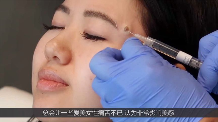 去痣手术安全吗?3D动画模拟手术全过程,看完你还嫌弃自己的痣吗