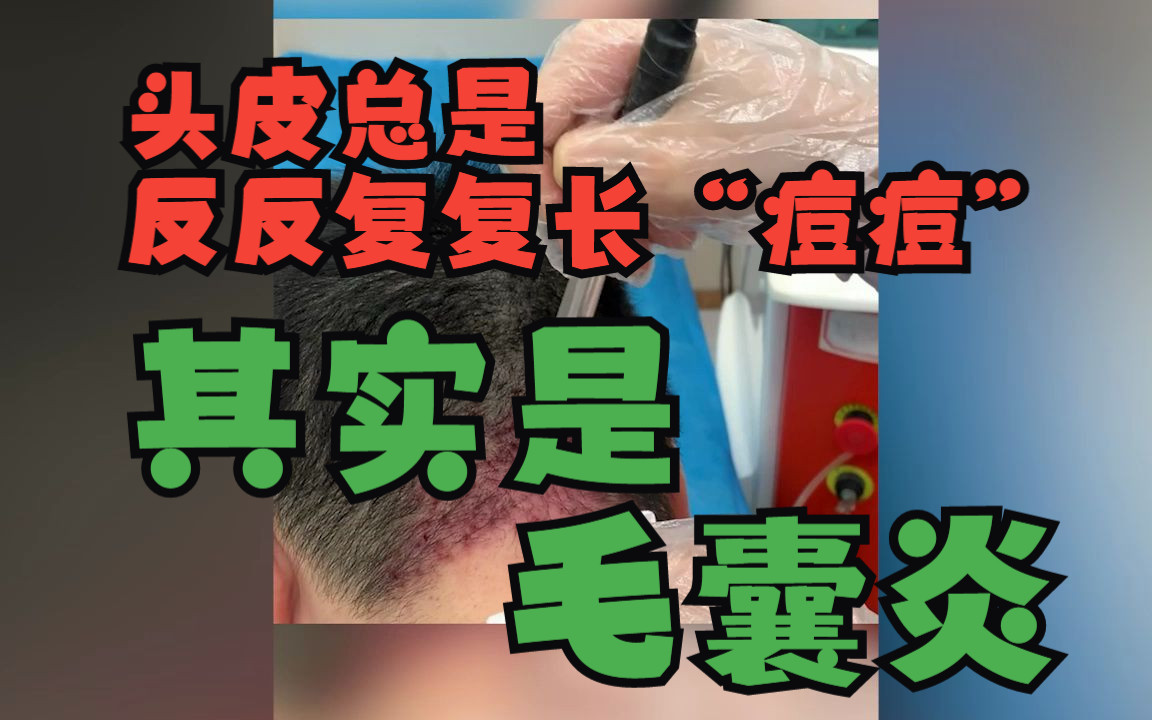【和毛囊炎说拜拜】头皮总是反反复复长“痘痘”,其实是毛囊炎.