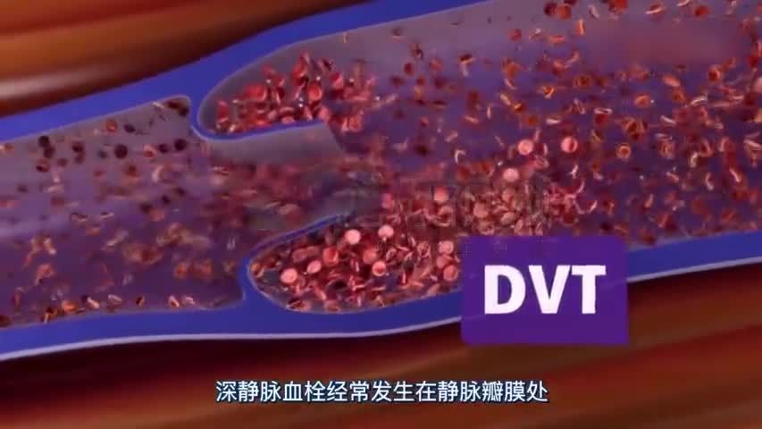 深静脉血栓的形成机制,严重的或#致命