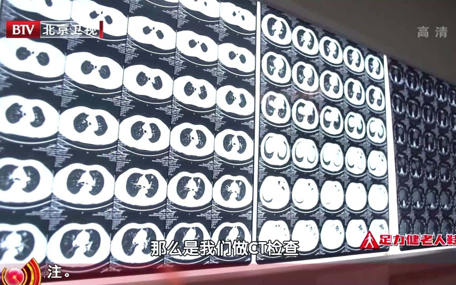李晓光大夫讲解CT如何发现肺部结节