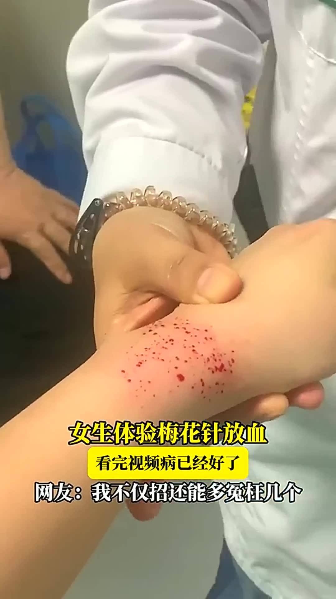 女生体验梅花针放血,看完视频病已经好了!