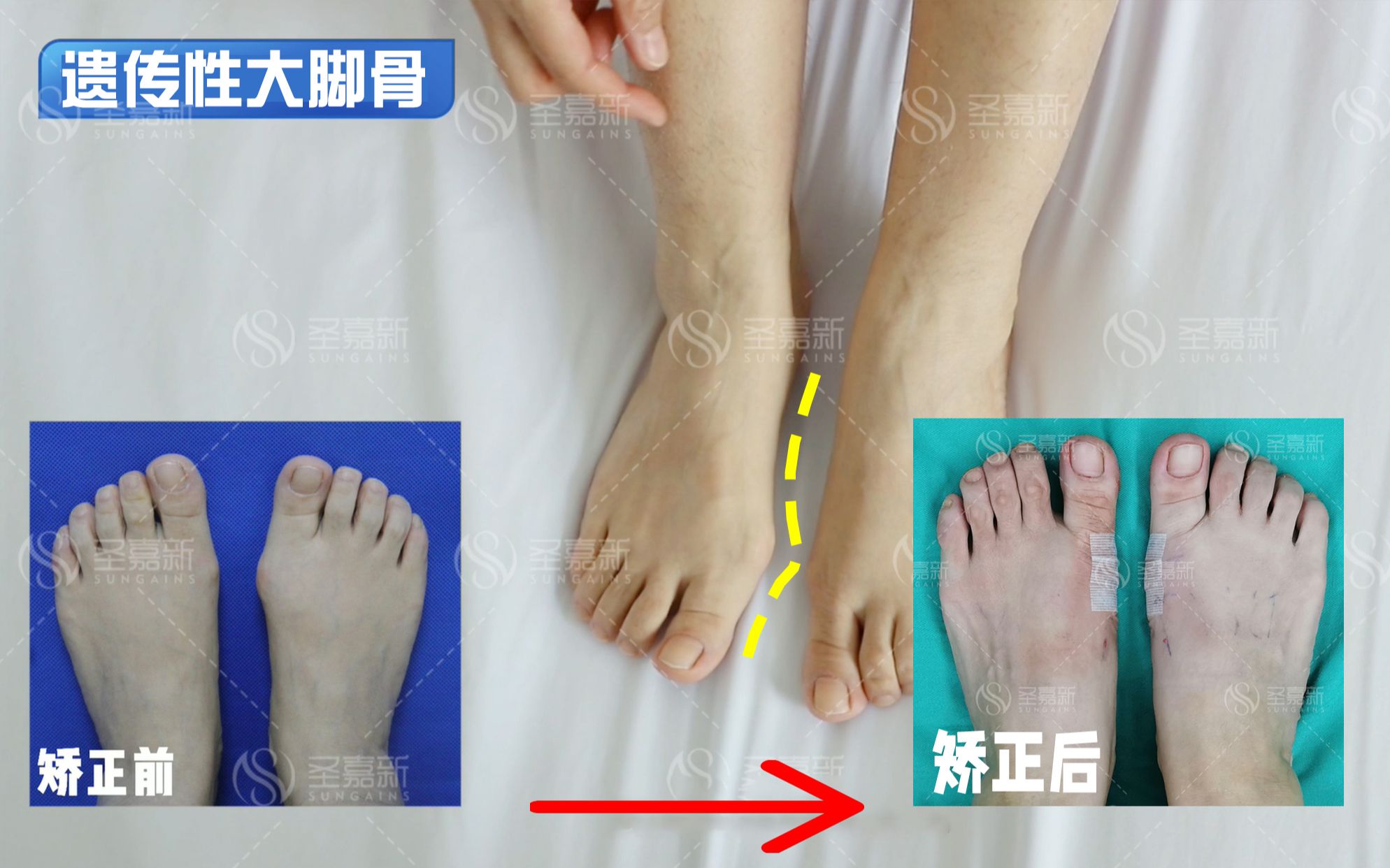 北京苏敬达医生:姑娘来做遗传性大脚骨,术后2个月了,解决了大麻烦