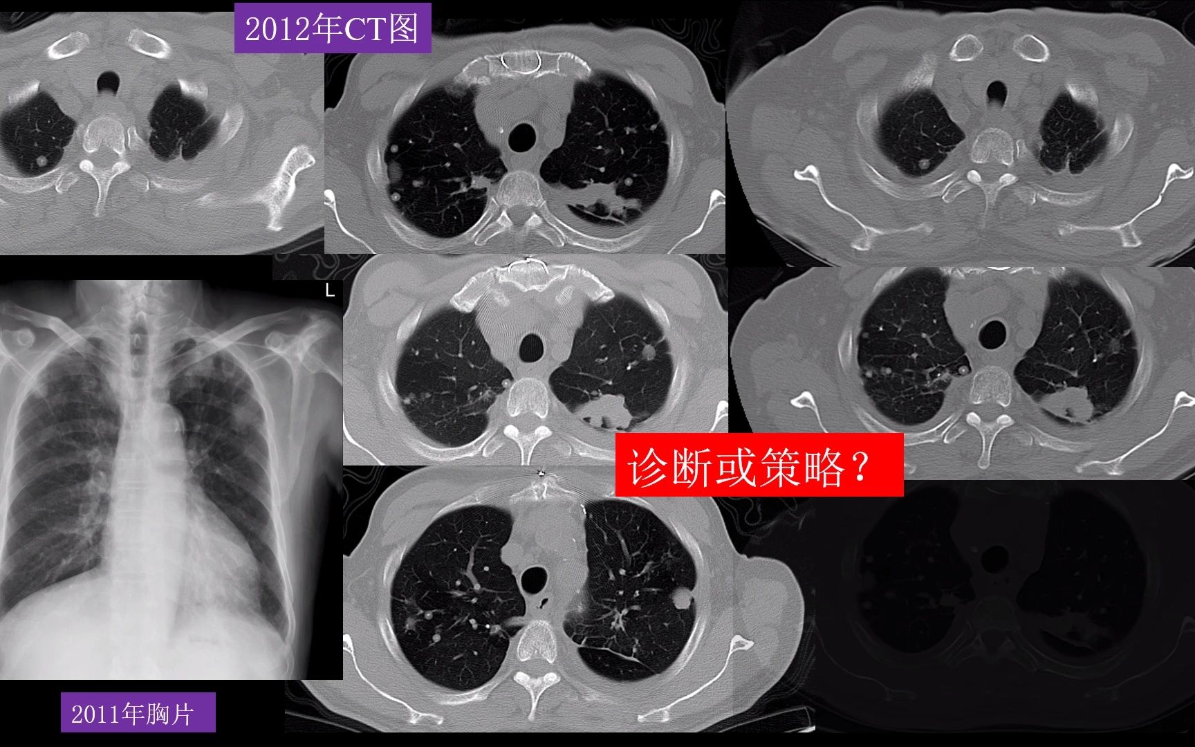 肺结节指南与临床实践,影像与诊断PPT