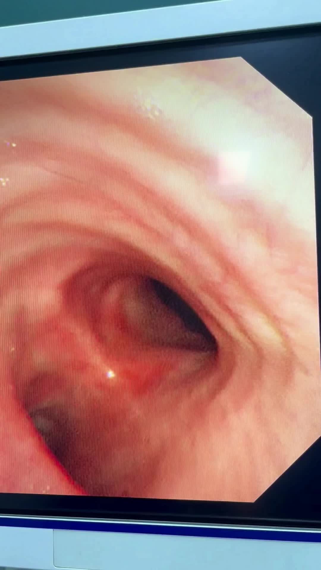 气道支架植入指征: l 结构性气道狭窄: 经处理后气道狭窄在70%以上者...