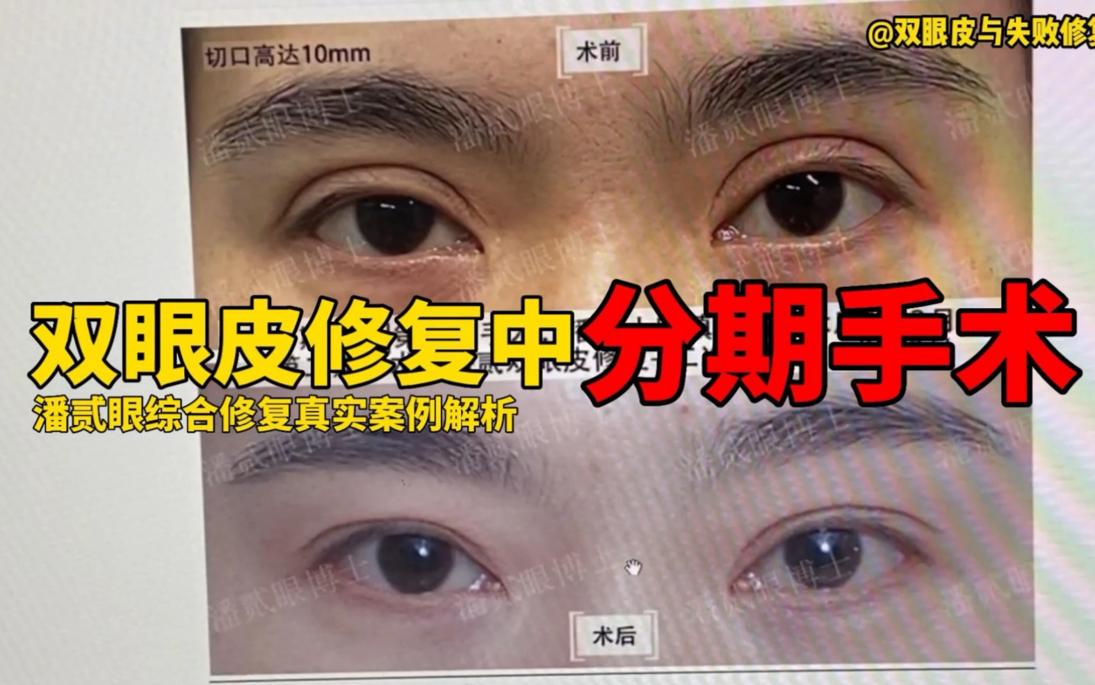 双眼皮修复中的分期手术是什么情况?潘贰眼综合修复真实案例解析
