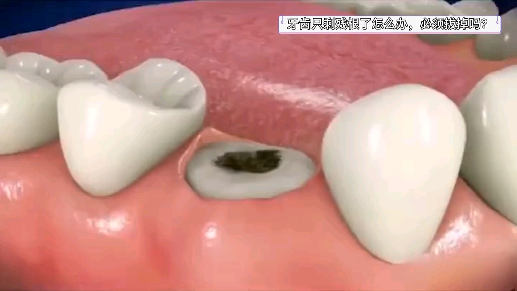 牙齿只剩残根了怎么办,必须拔掉吗?