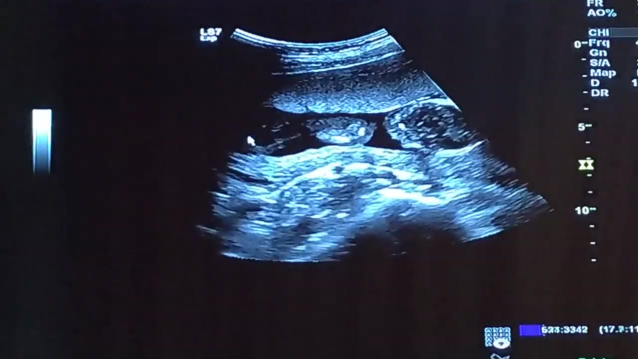 怀孕第14周B超产检过程实录,宝宝全程趴着不给看关键部位!