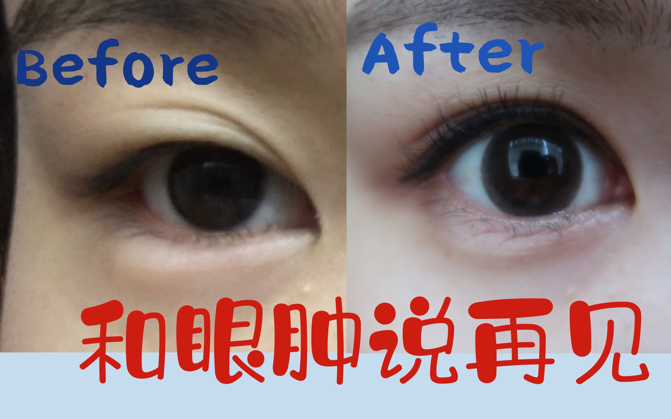 消除眼肿 眼睛去水肿方法,和肿眼泡说拜拜