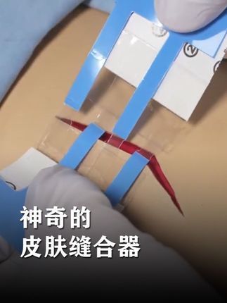 不可思议的皮肤缝合器,一粘一拉,无需缝线就能闭合伤口 #拉链创可贴 #...