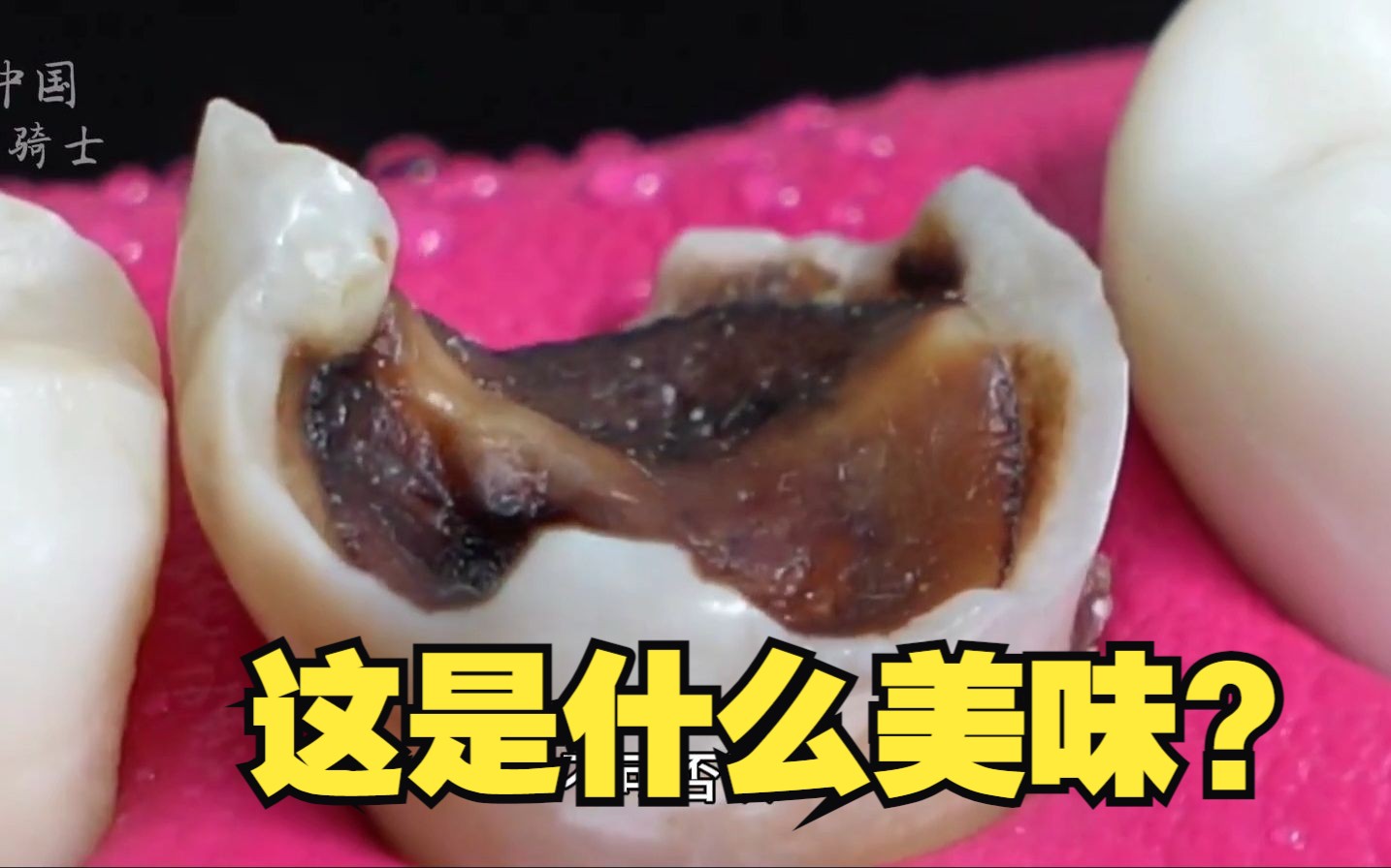 令人惊叹的蛀牙修复手术,被掏空的牙齿最后竟然能完美修复!