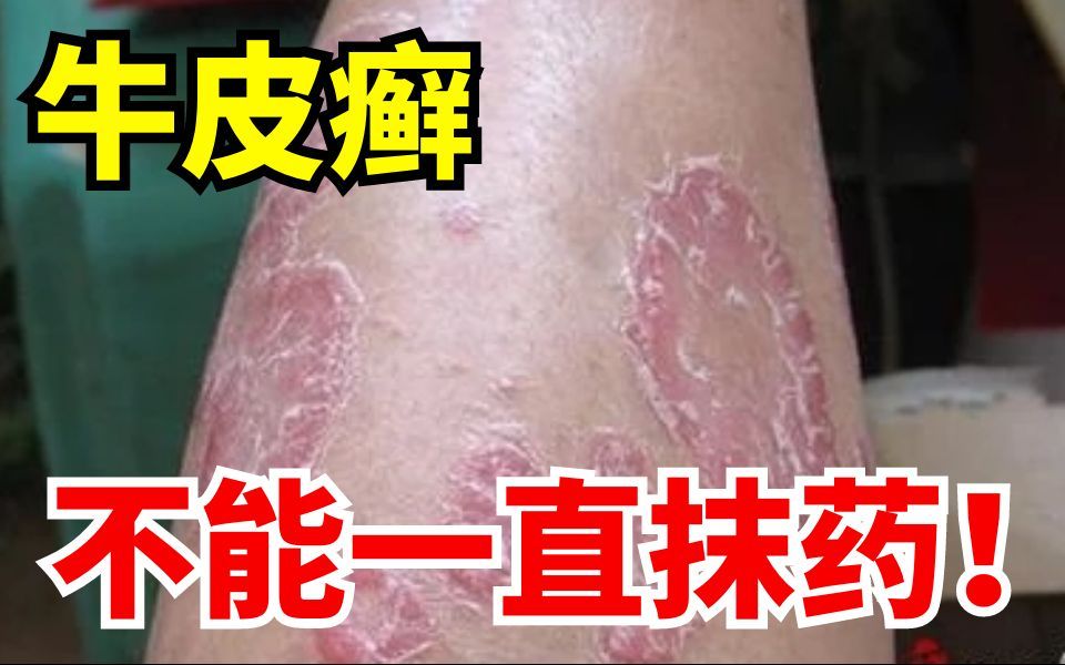 身上长了一堆牛皮癣,医生劝告:不要再抹药了!
