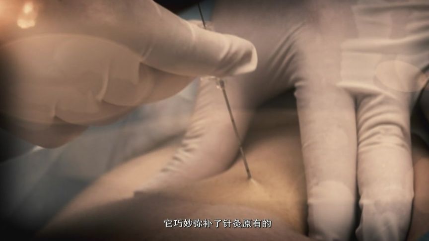 中医穴位埋线究竟是什么线?什么穴?怎么埋?