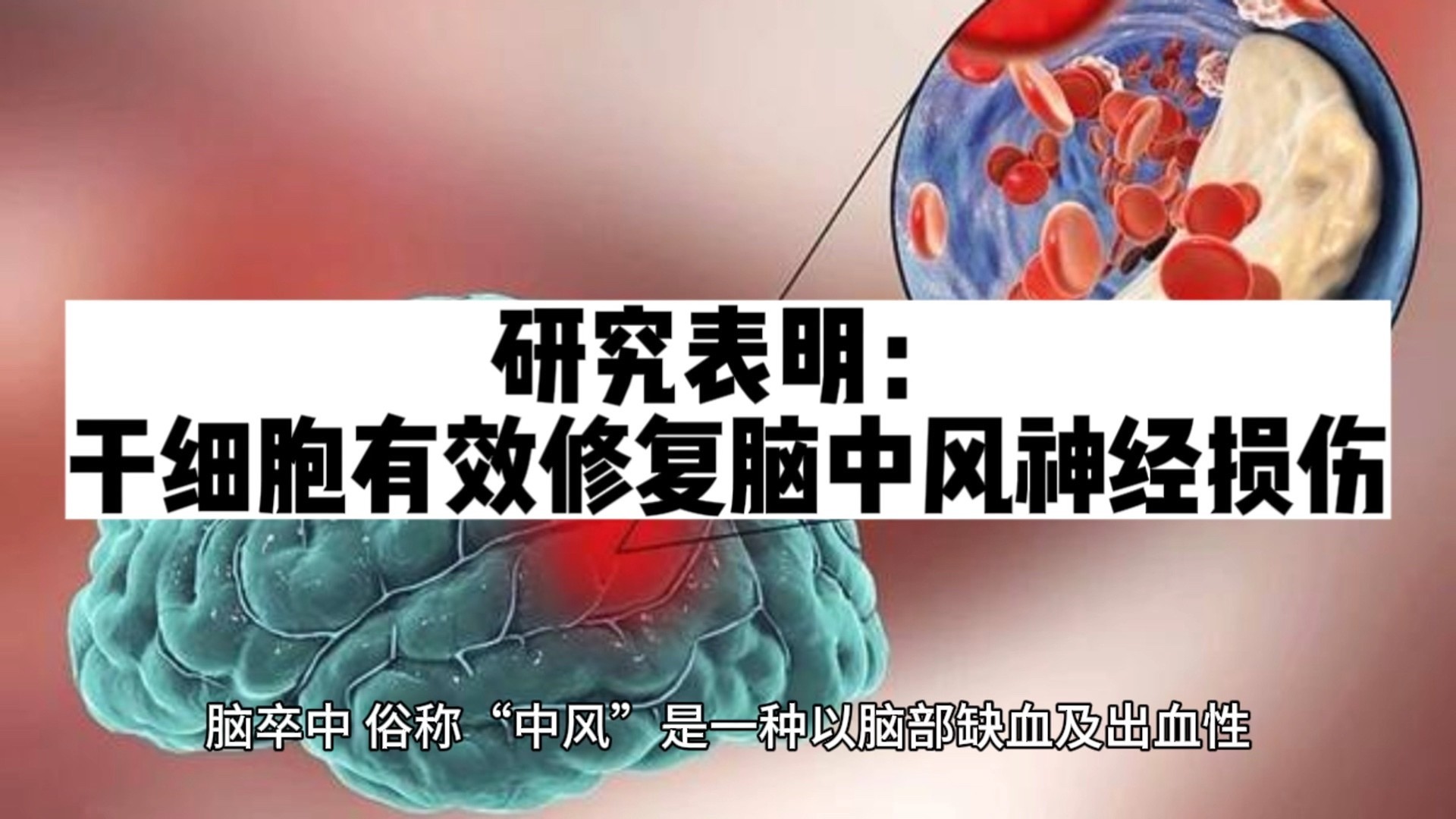 研究表明:干细胞有效修复脑中风神经损伤