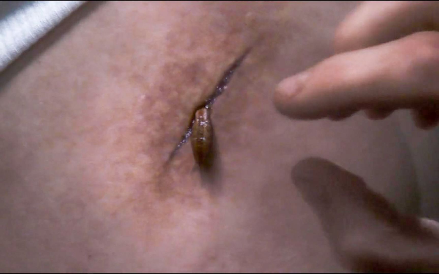 女子体内钻入一条寄生虫,在她体内疯狂产卵,最后痛苦死去