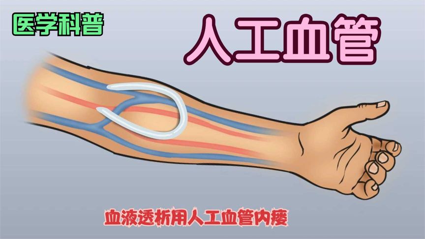 医学科普:透析用人工血管内瘘演示视频