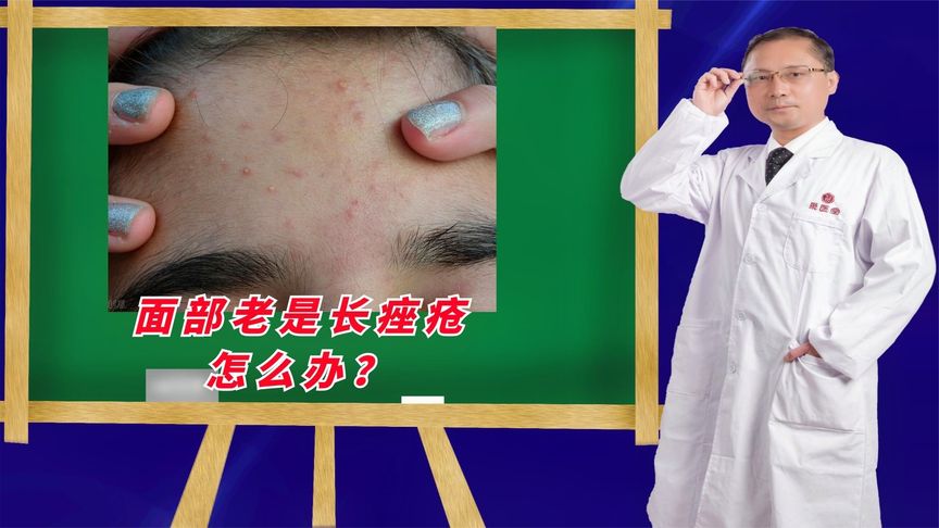 面部老是长痤疮,怎么办?老中医有妙招,或能轻松缓解