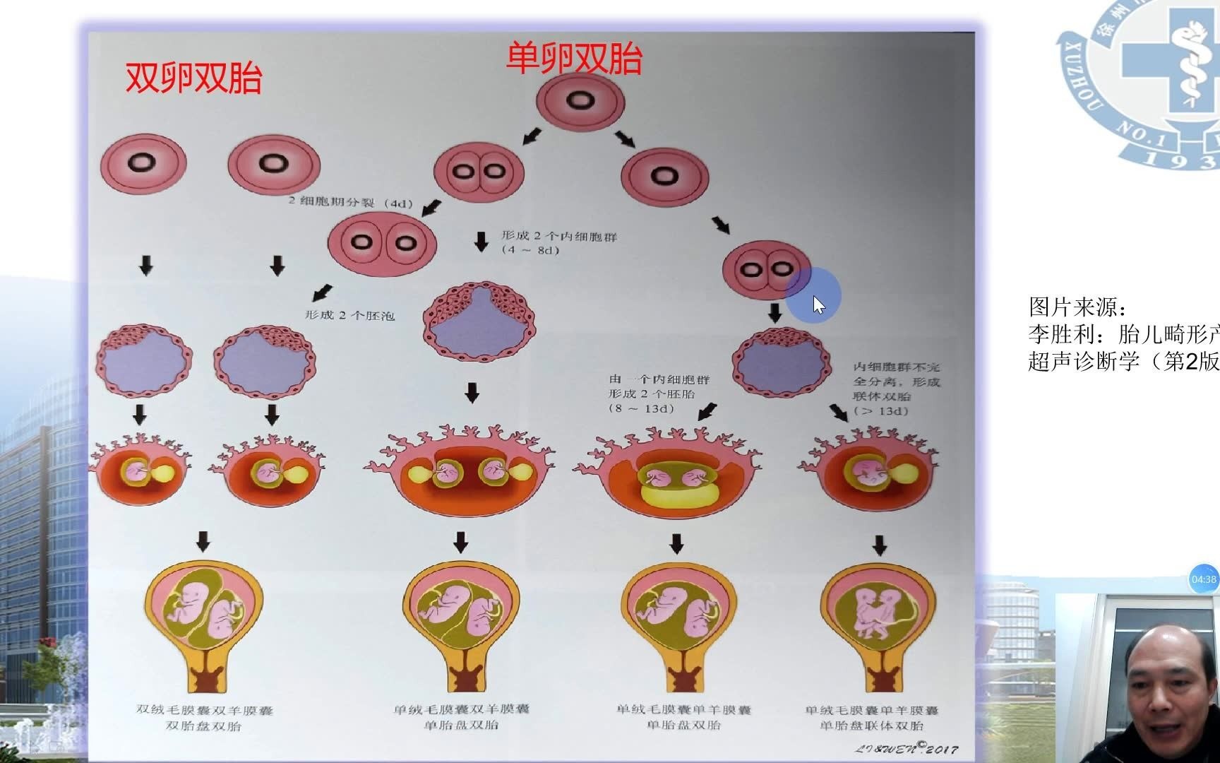 双胎妊娠超声检查