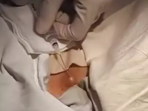气管切开
