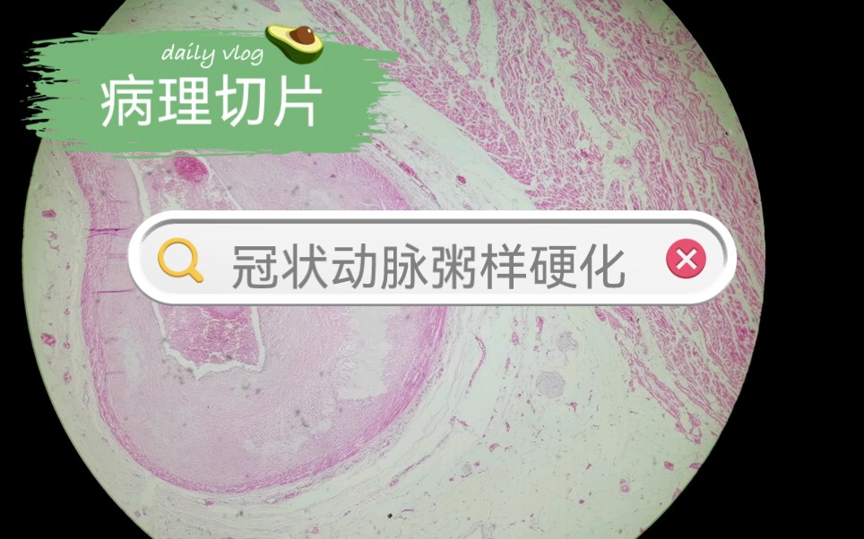 【病理实验切片】冠状动脉粥样硬化