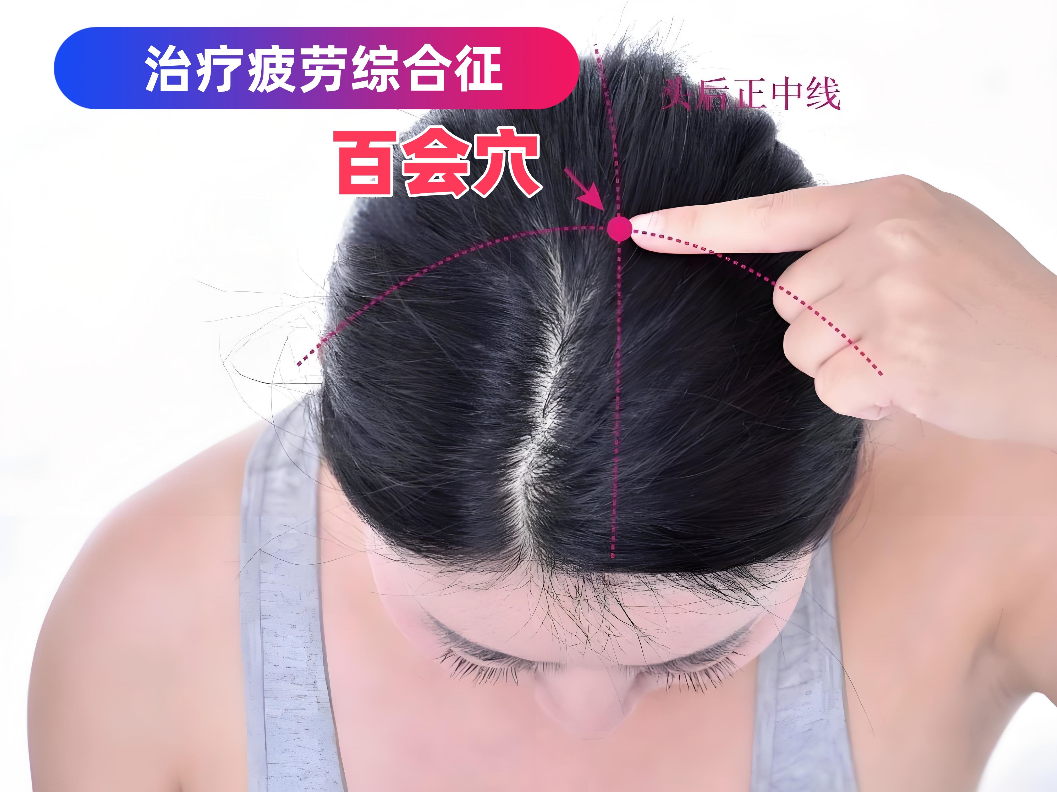 217、督脉 — 百会穴 — 治疗疲劳综合征