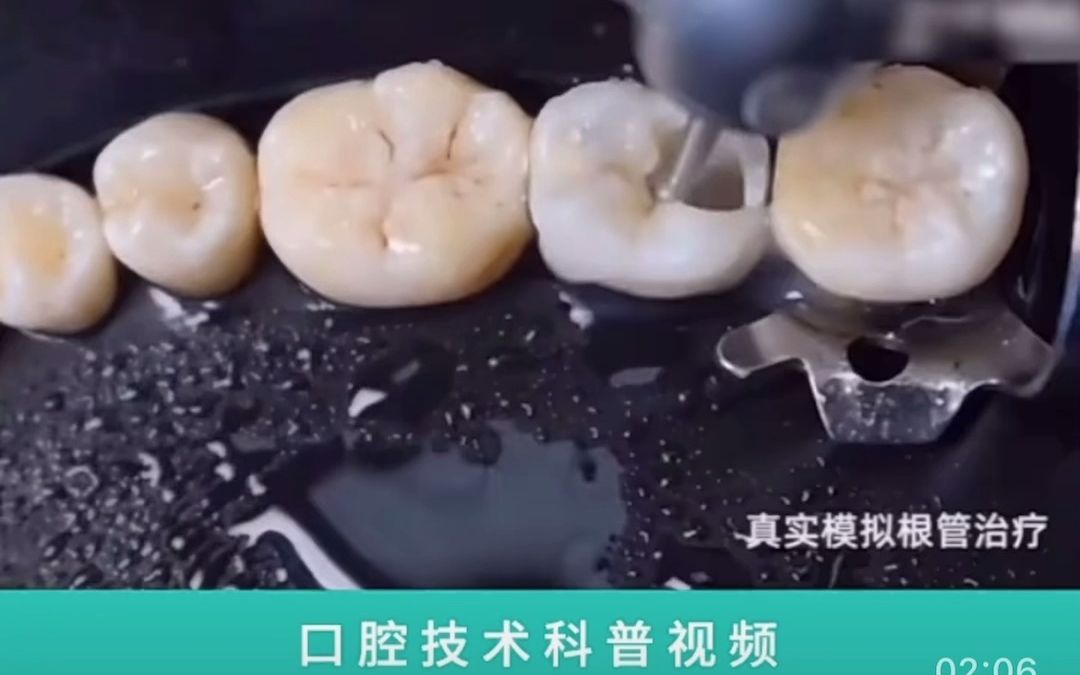 根管治疗是什么?