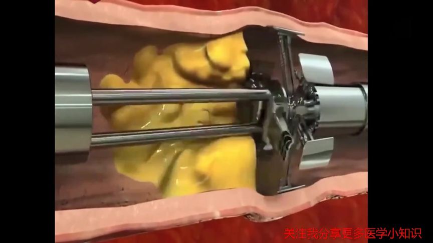 2分钟科普,带你看各种血管堵塞清除手术
