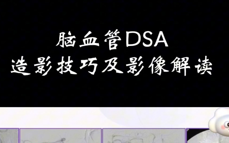脑血管DSA造影技巧及影像解读(共18节)
